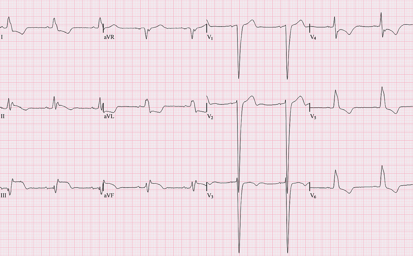 Left Bundle Branch Block Ecg
